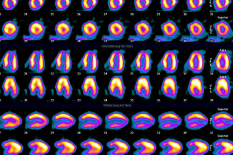 Myocardial Perfusion Scan | Dr Miles Dalby